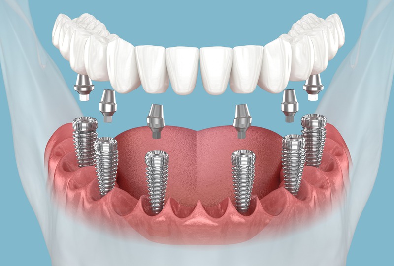How Can I Ensure My Dental Crowns Last Longer? - Totix